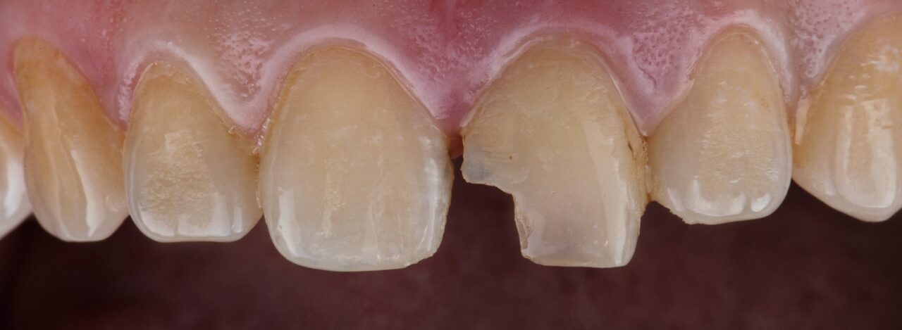 How to Fix a Chipped Front Tooth | Emergency Dental Care | Walk-In ...